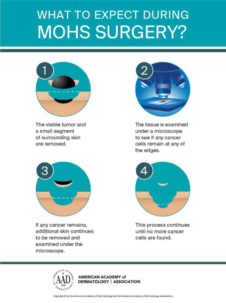 Mohs Surgery | Surgical Dermatology Group